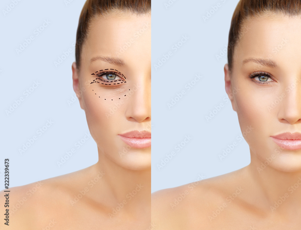 Lower and upper Blepharoplasty.Marking the face.Perforation lines on ...