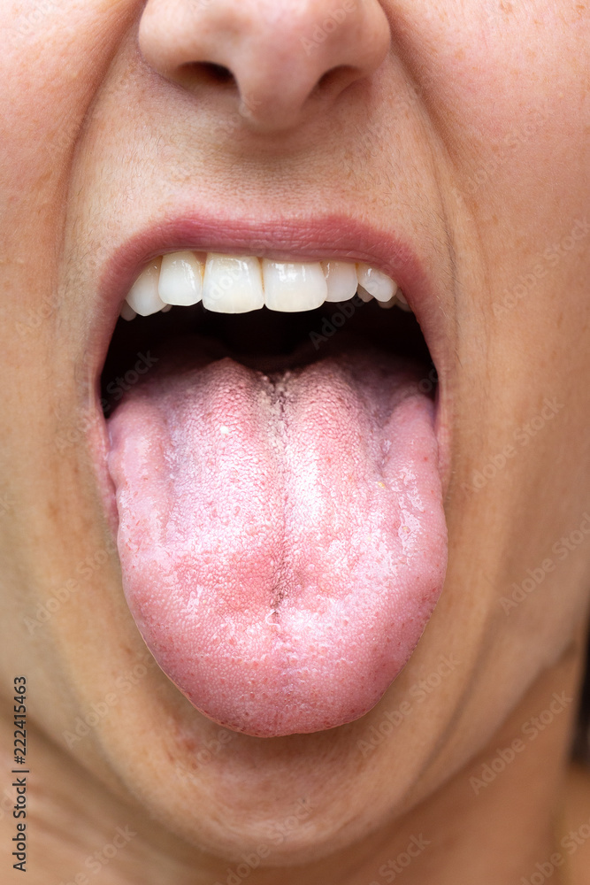 Candidiasis on female tongue Stock Photo | Adobe Stock