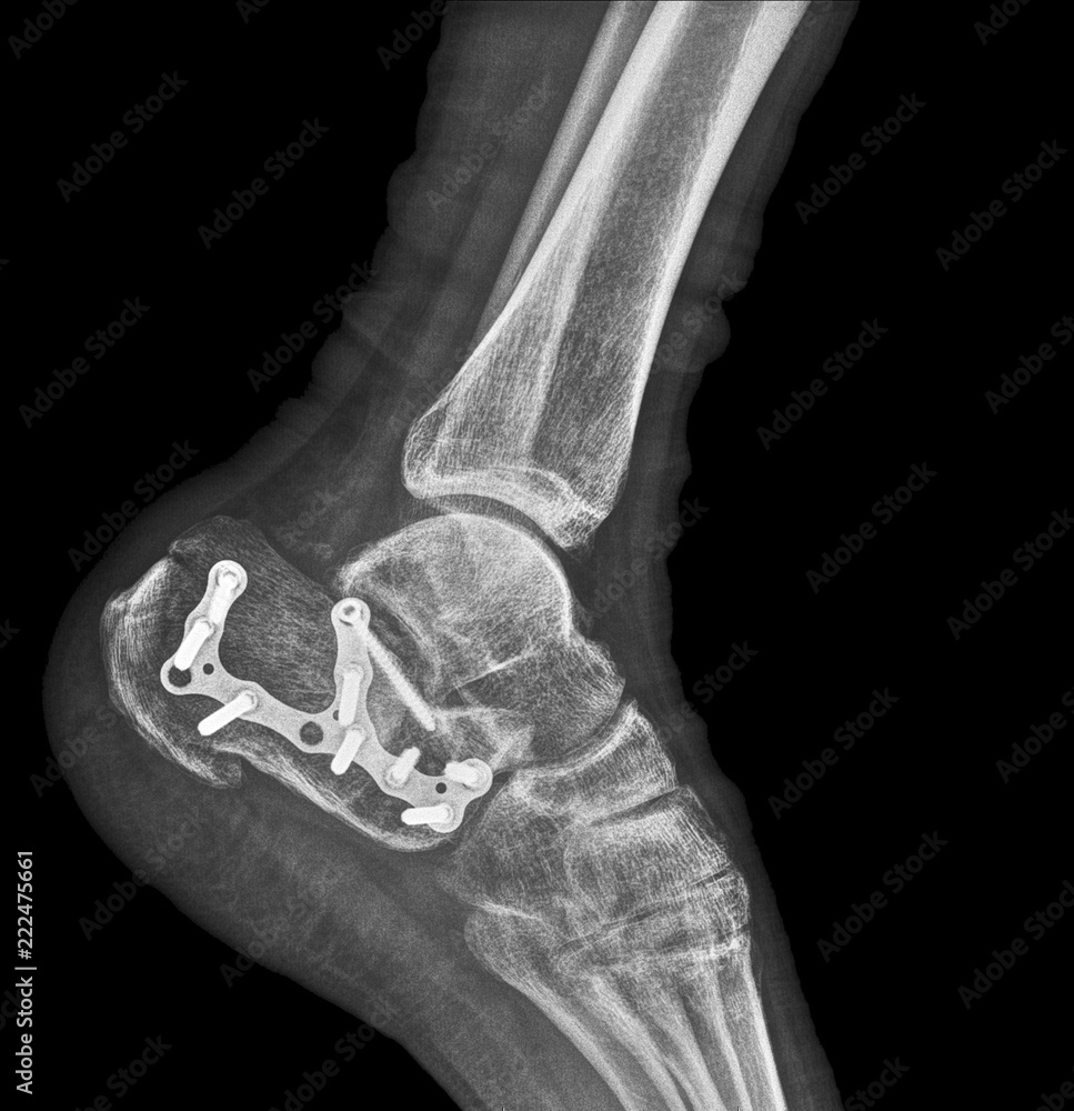 X-ray of a calcaneus fracture osteosynthesis Stock Photo | Adobe Stock