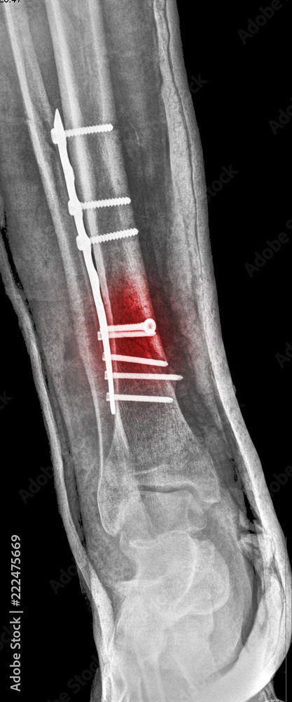 X-ray traumatological osteosynthesis with crural bone fracture plates ...