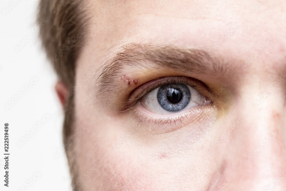 Injured eye. The wound on the upper eyelid, bruising and swelling after ...