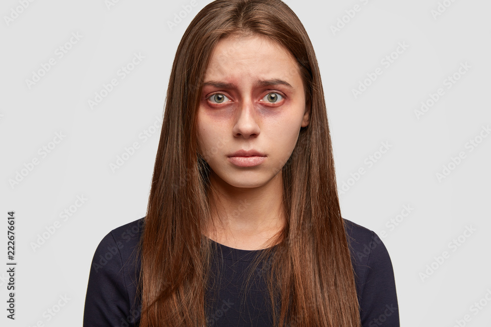Sad European girl with bruises around eyes, being victim of aggressive ...