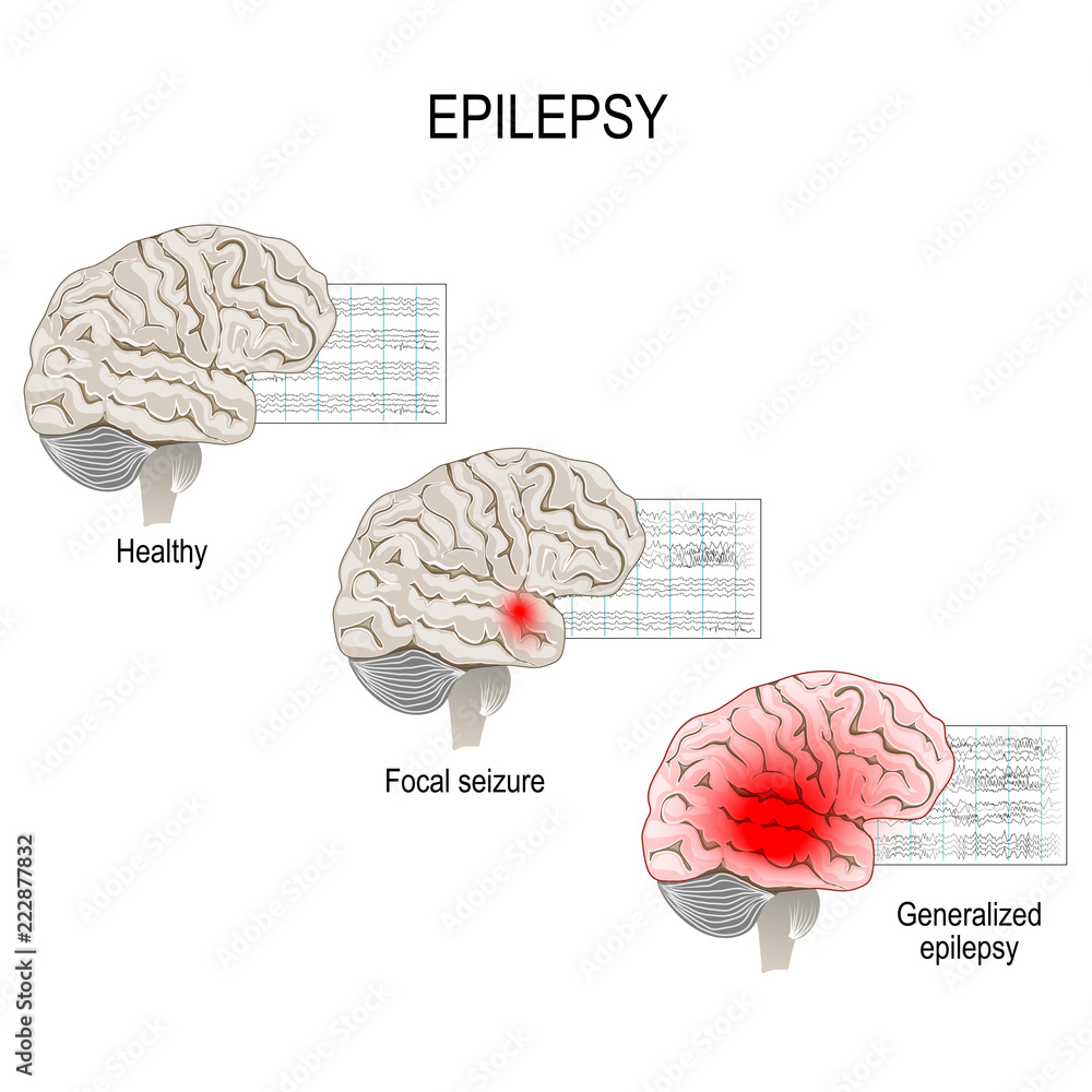 Epilepsy Brain Vs Normal Brain