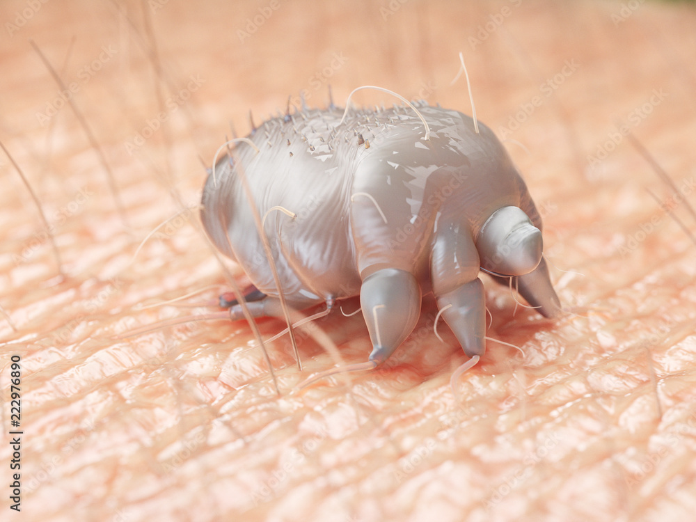 3d rendered medically accurate illustration of a scabies mite on human ...