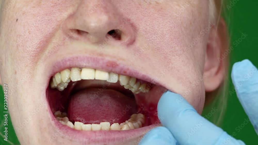 Vidéo Stock A woman with stomatitis on her cheek. Consequences after ...
