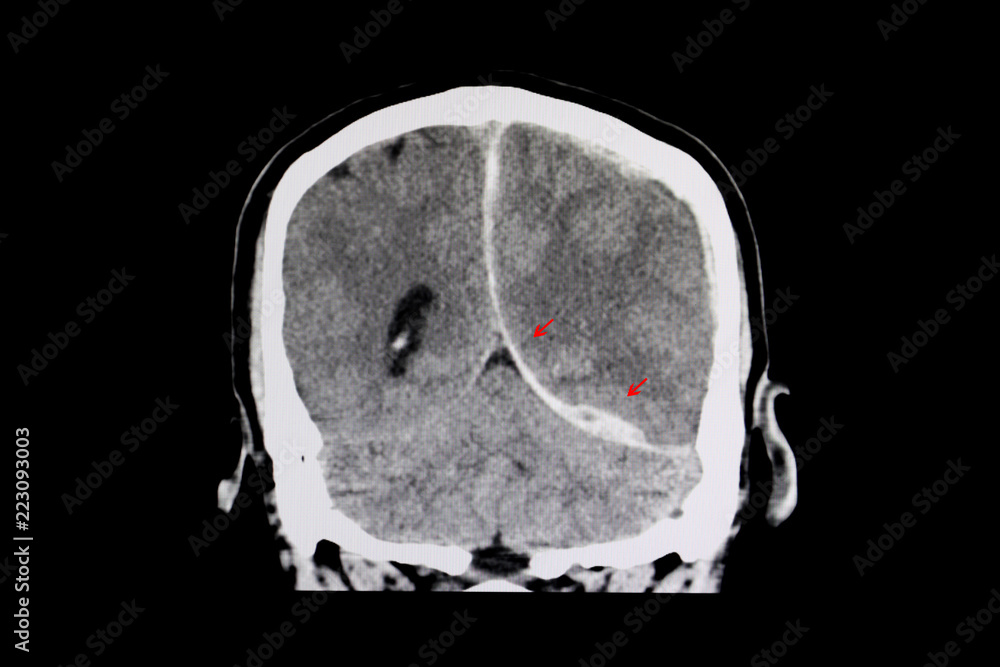 CT scan of a brain of a patient with interhemispheric hemorrhage from ...