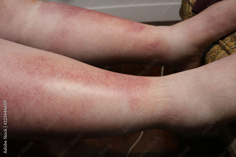 terrible sun burn on females leg that has caused sun poisoning Stock ...