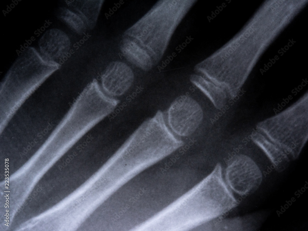 x-ray film skeleton human arm. health medical anatomy body concept ...