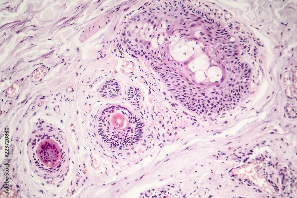 Basal cell carcinoma, skin cancer, light micrograph, photo under ...