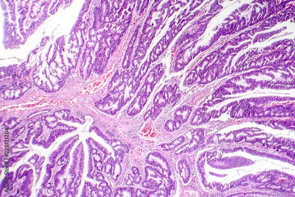 Colon adenocarcinoma, light micrograph, photo under microscope Stock ...