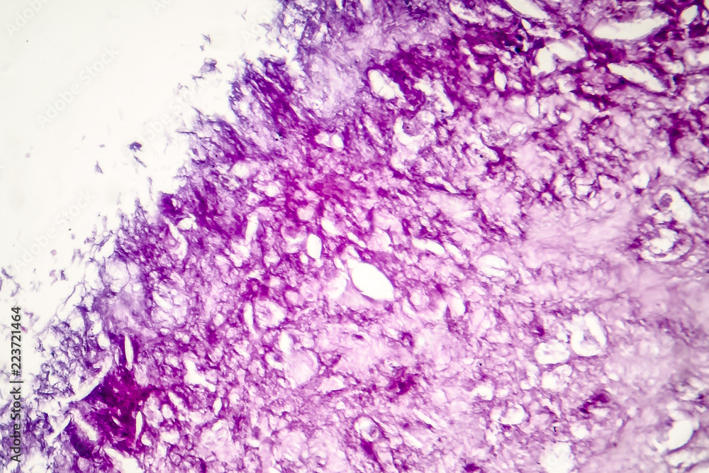 Melanocytes Melanoma