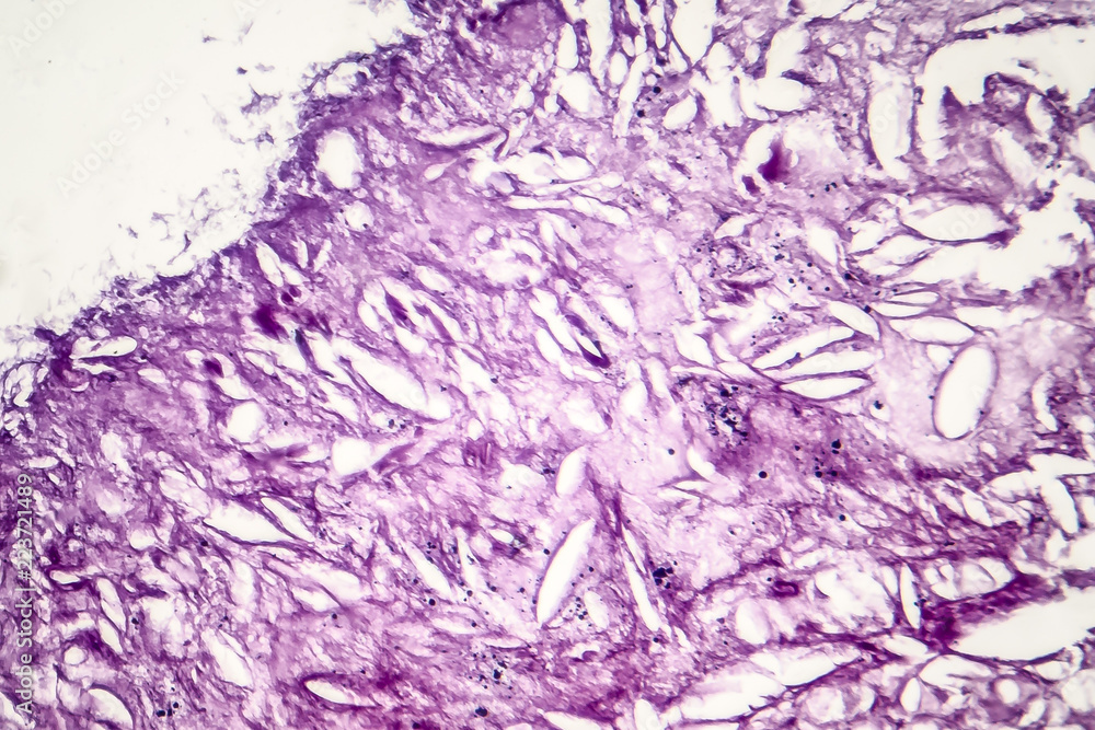 Melanoma, a cancer developing from pigment-containing cells melanocytes ...