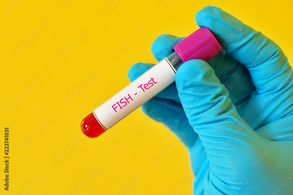Blood sample for fluorescence in situ hybridization or FISH test ...