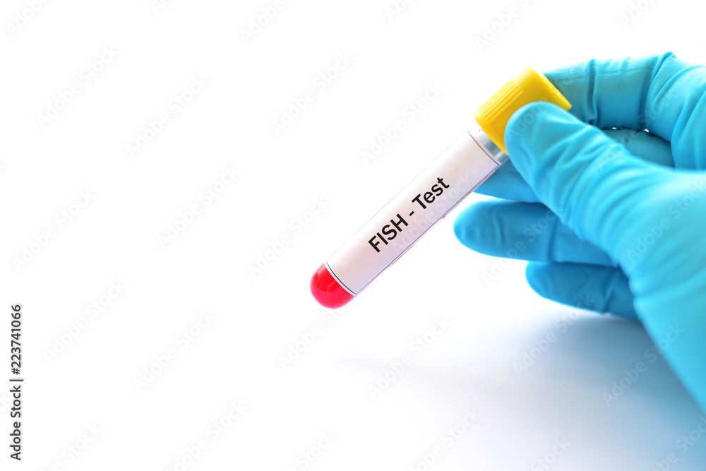 Blood sample for fluorescence in situ hybridization or FISH test ...