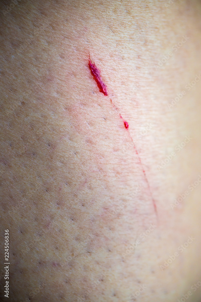 Closed-up of a scratch fresh wounds on shin. concept of Accident ...
