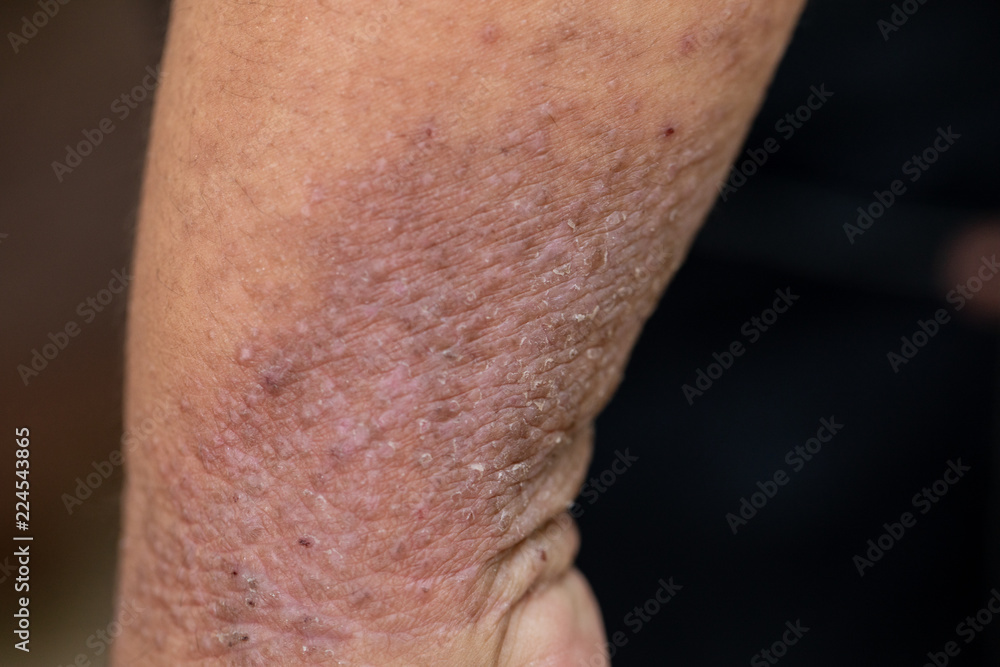 A physical of Atopic dermatitis (AD), also known as atopic eczema, is a ...