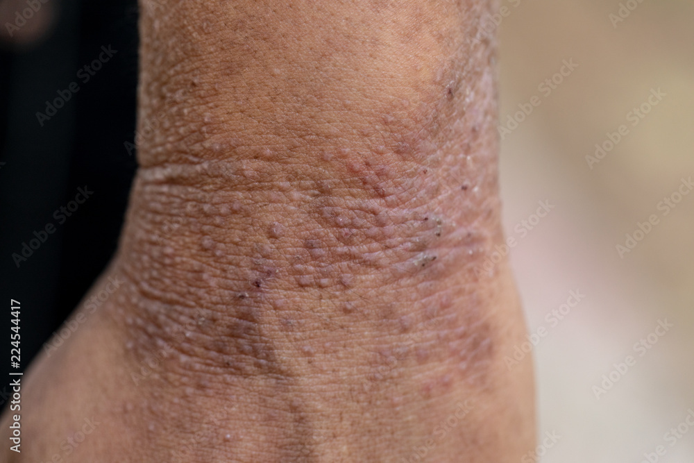 A physical of Atopic dermatitis (AD), also known as atopic eczema, is a ...