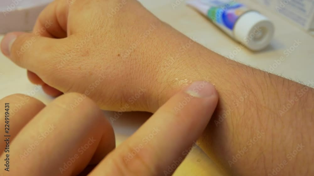 Stockvideo Decontamination and disinfection of the wound. Applying the ...