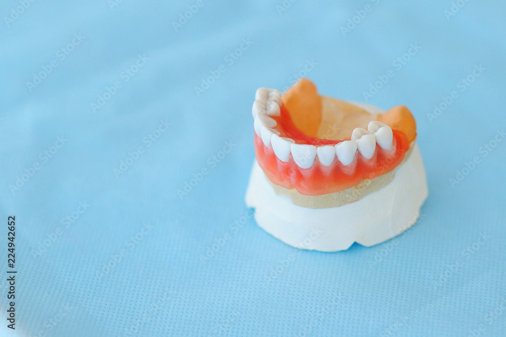 Denture on a blue background. Dental prosthetics for teeth. Place under ...