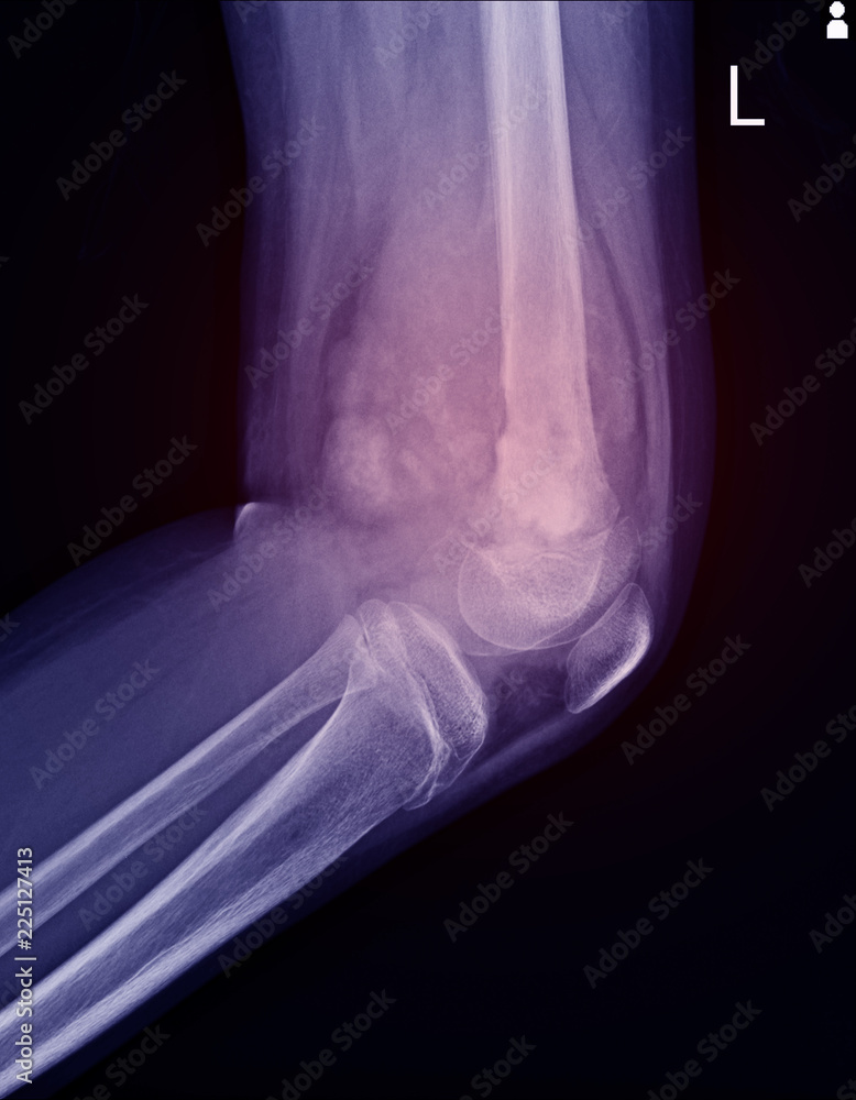 X-ray Knee join Showing large osteolytic lesuion of medial aspect of ...
