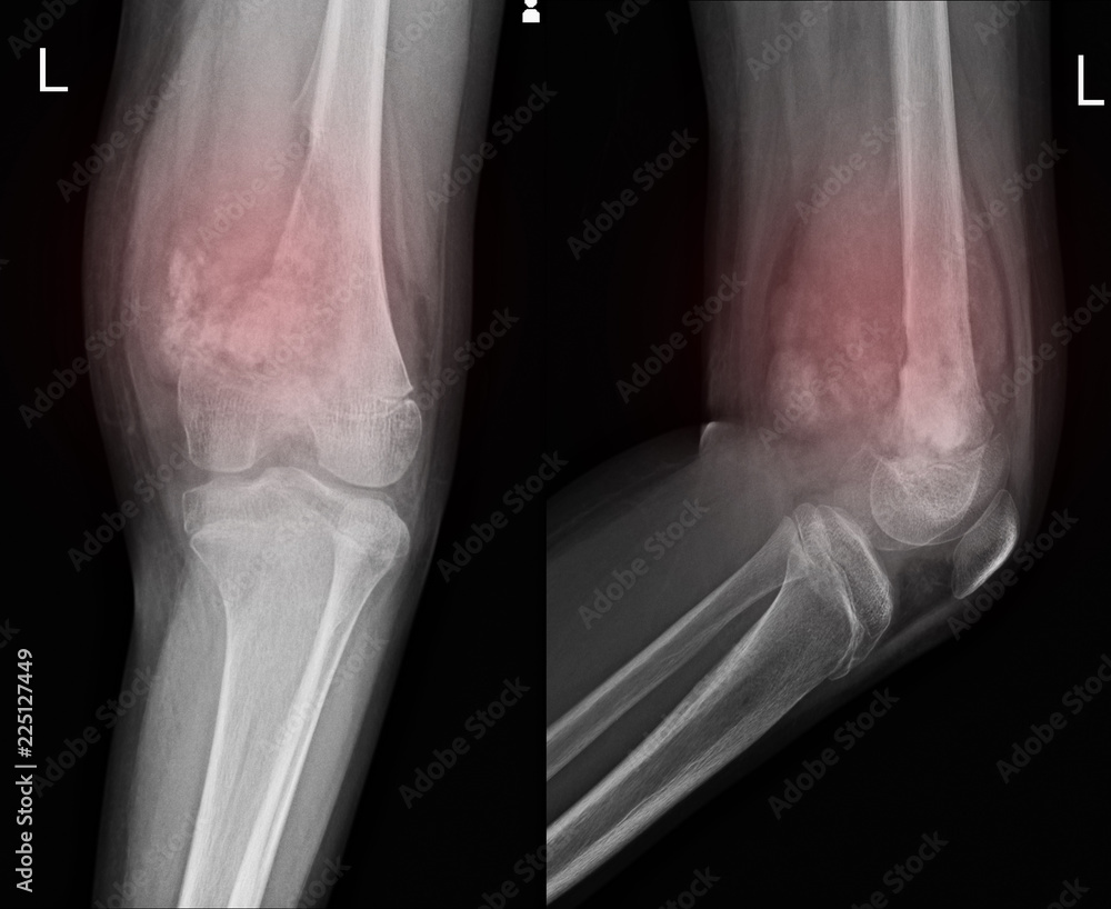 Osteosarcoma Knee X Ray