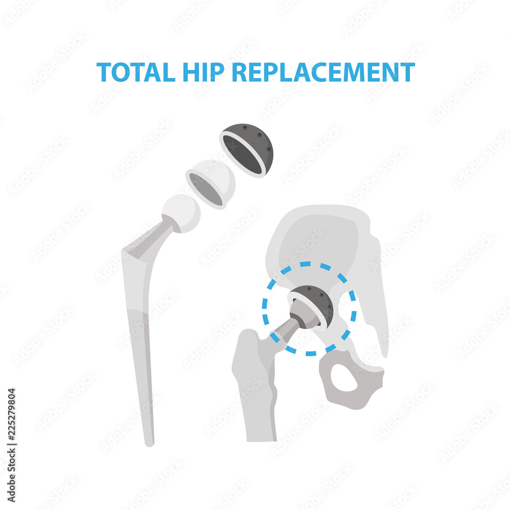 Osteoarthritis of the Hip Joint and Hip Replacement Surgery medical ...