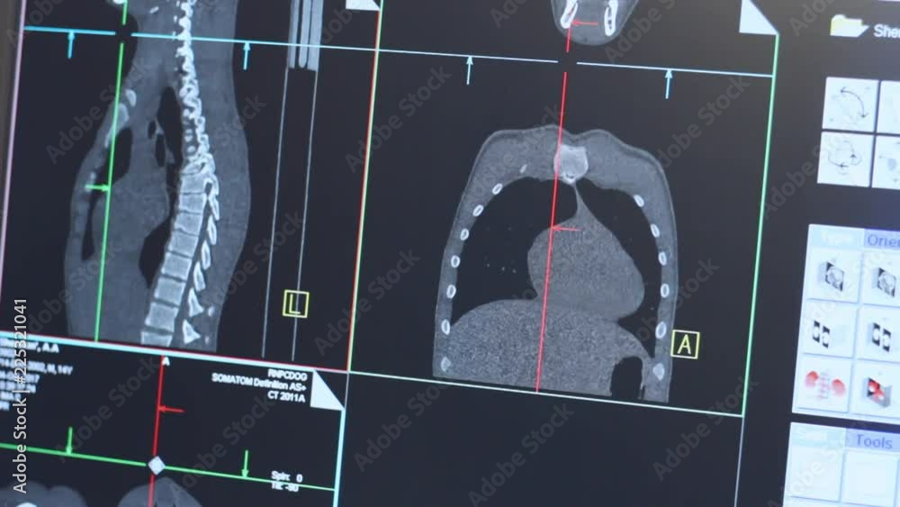 Magnetic resonance image of human body on monitor. Ct-scan expertise in ...