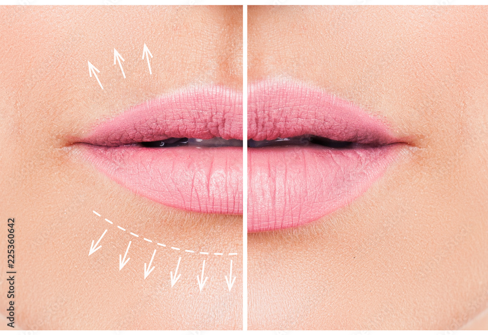 Beautiful pink lips before and after filler injection collagen to ...