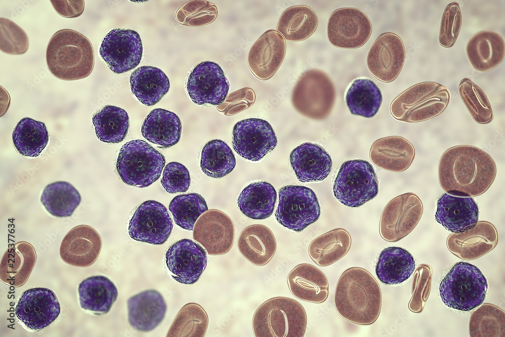 Acute lymphoblastic leukemia, bone marrow smear Stock Illustration ...