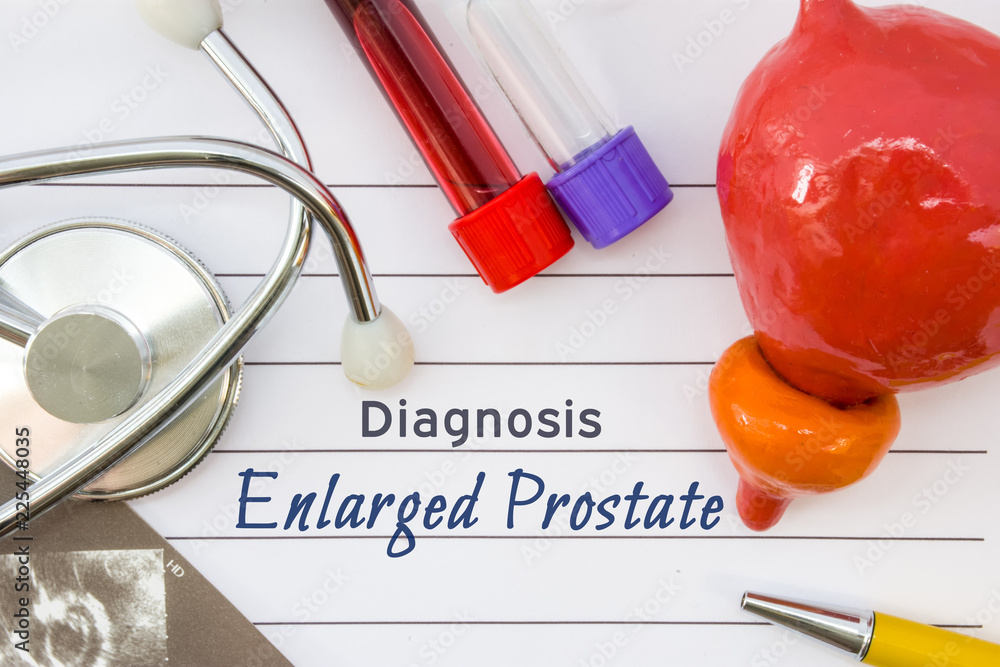 Diagnosis of Enlarged Prostate. Figure of prostate is located next to ...