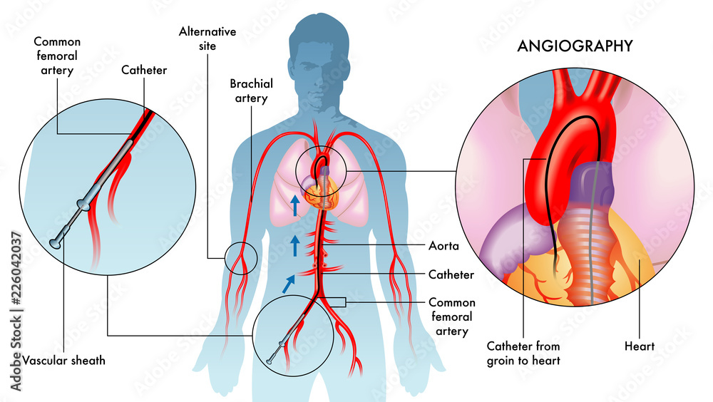 Labelled illustration of coronary angiography operations on adult male ...
