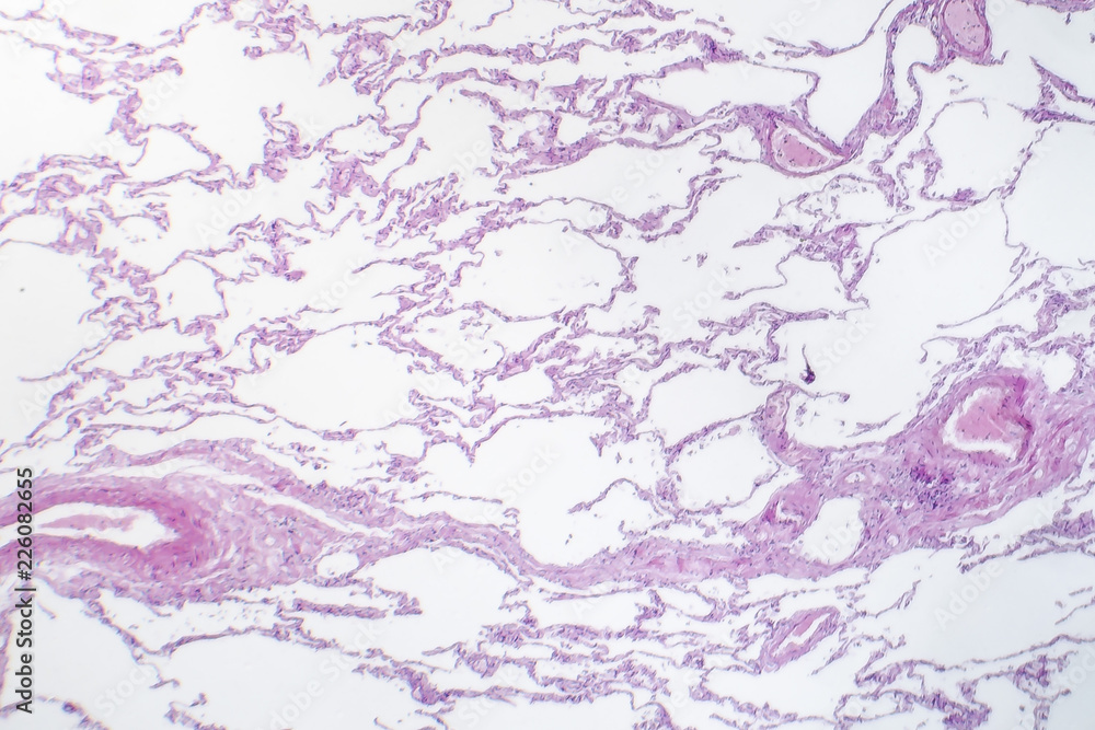Diffuse lung emphysema, light micrograph, photo under microscope Stock ...