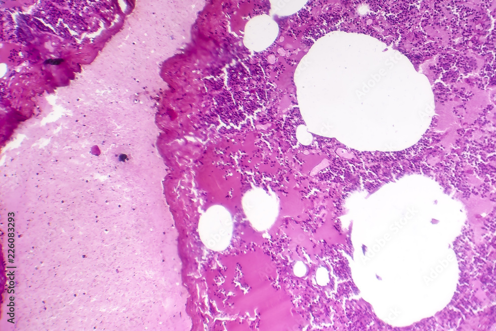 Lobar pneumonia, hemorrhagic edema period, light micrograph, photo ...