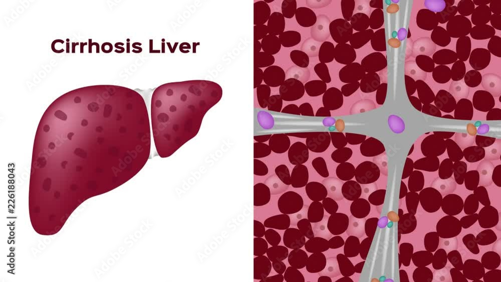 Normal liver Fatty liver and Cirrhosis liver graphic animation vídeo do ...