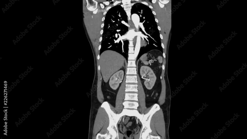 CT Scan ( Computed tomography ) of whole abdomen with contrast media ...