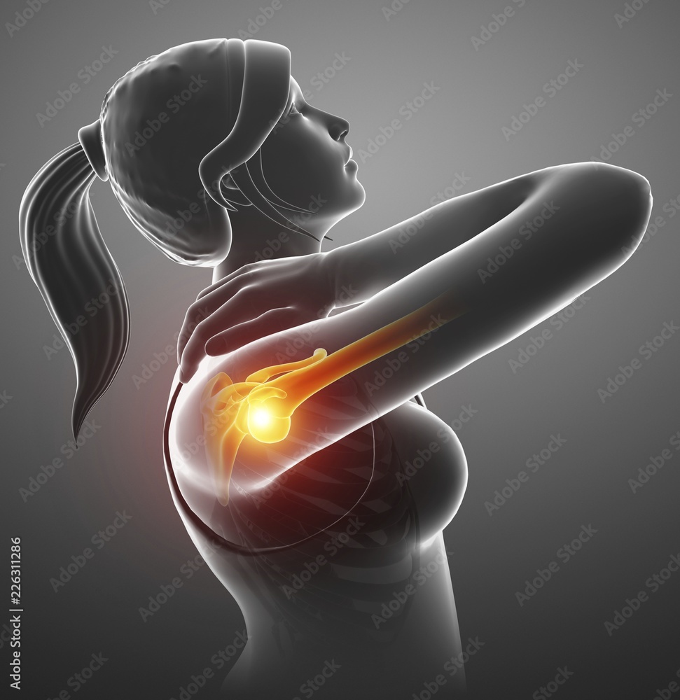 Woman with a painful shoulder, illustration Stock Photo | Adobe Stock