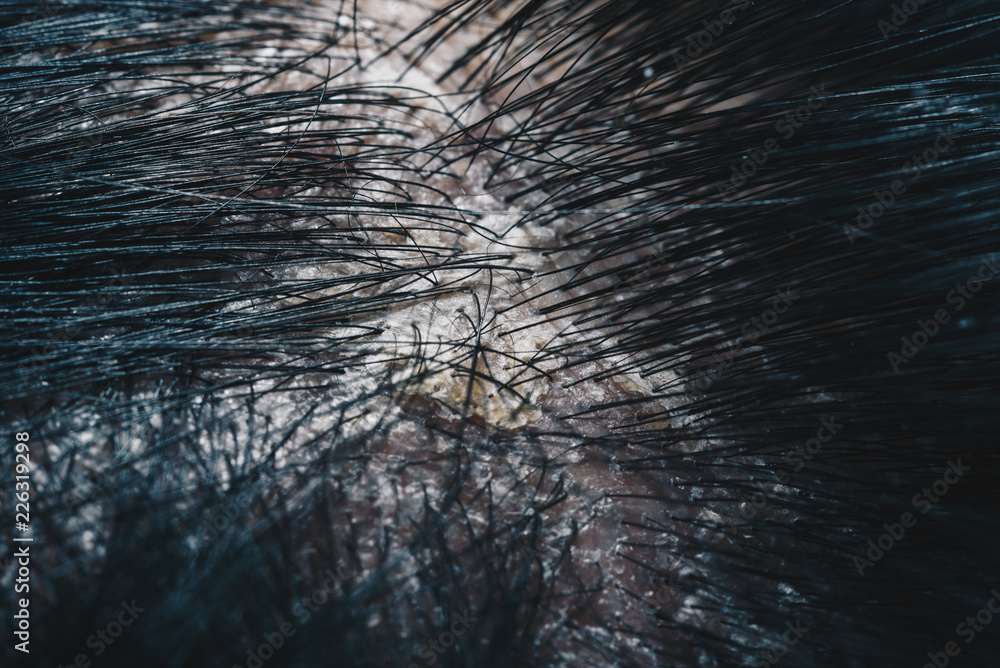 Hair scalp with dandruff and scaly from psoriasis Stock Photo | Adobe Stock