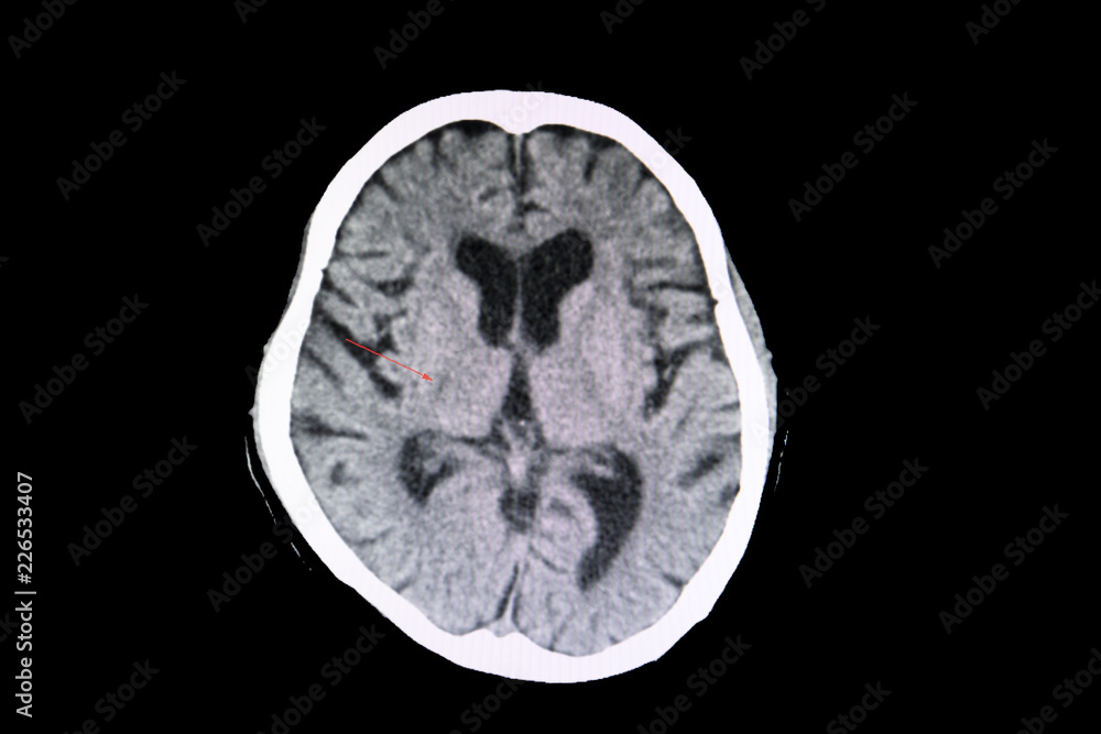 CT scan of patient with cerebral infarction Stock Photo | Adobe Stock