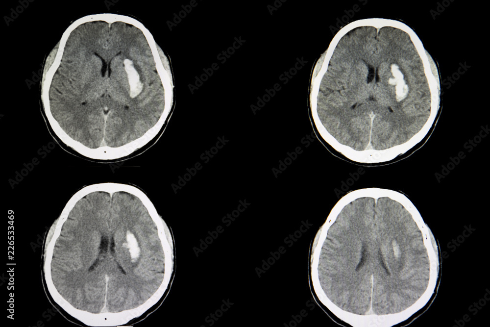 CT scan intracerebral hemorrhage Stock Photo | Adobe Stock