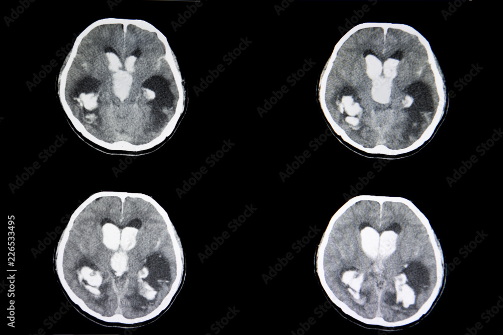 CT scan intracerebral hemorrhage Stock Photo | Adobe Stock