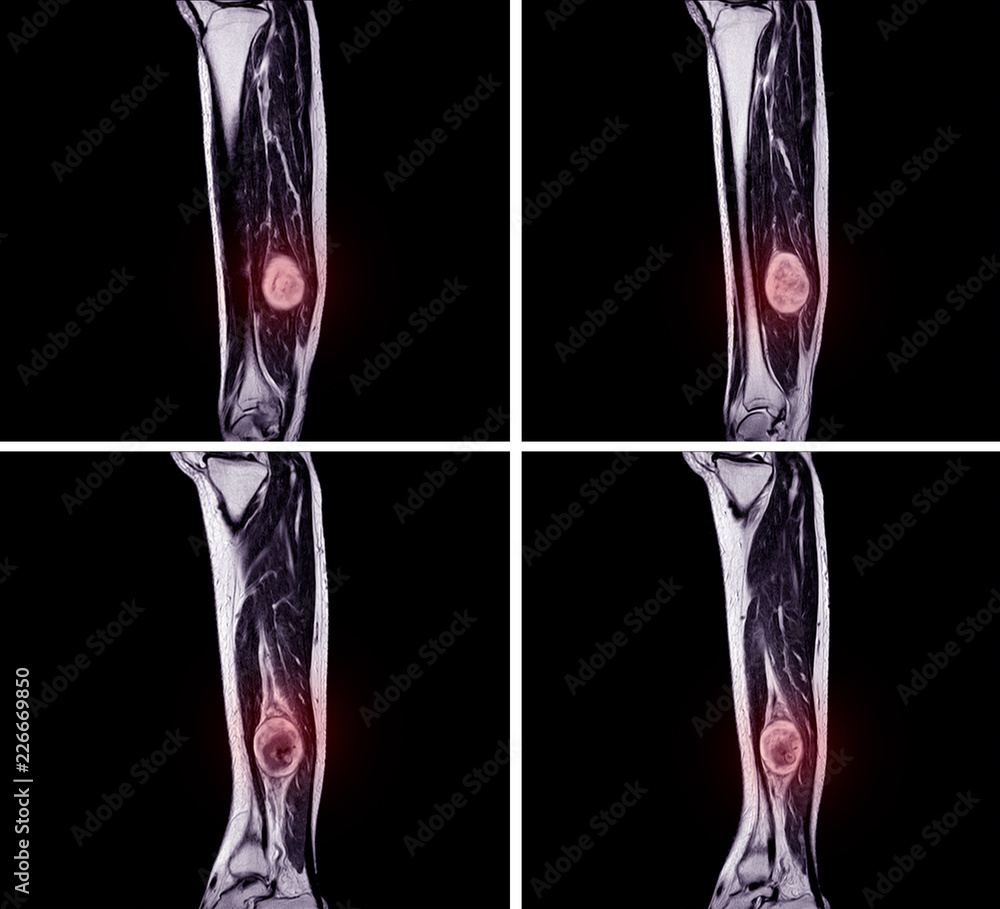 MRI (Magnetic resonance imaging) of Leg.enhancing smooth fusiform mass ...