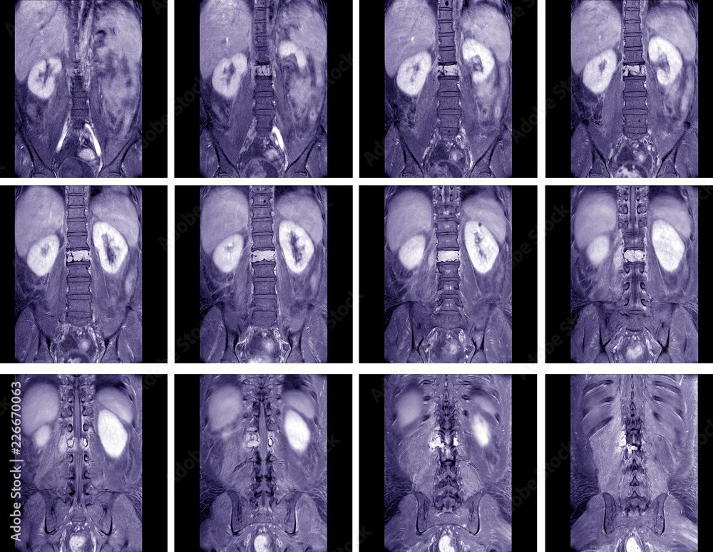 MRI OF THE LUMBOSACRAL SPINE:A 30 year-old male presented with low back ...