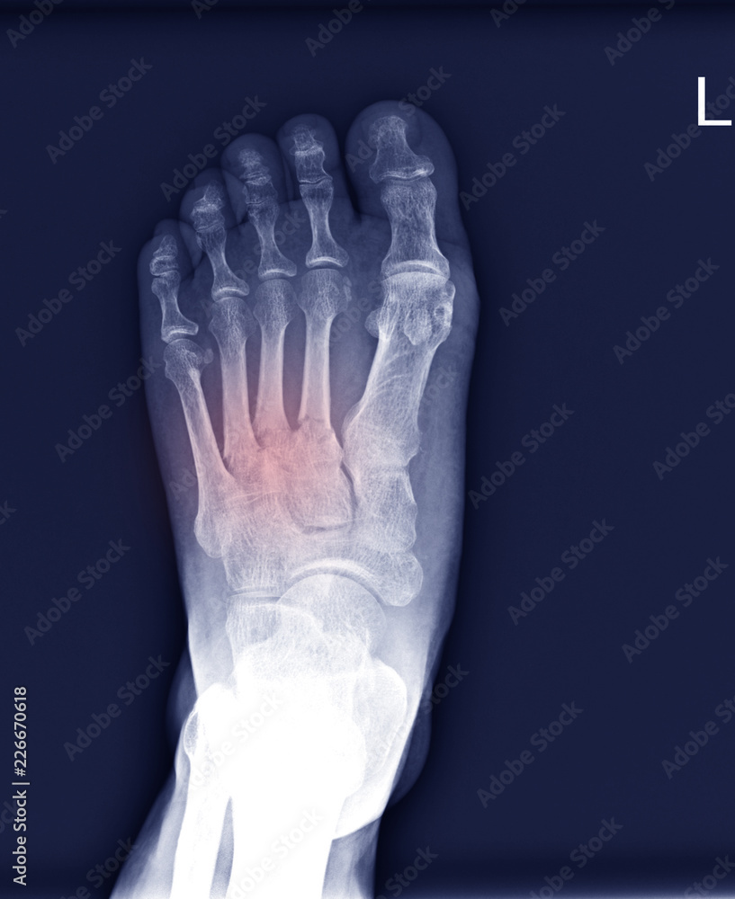 X-ray foot AP Fracture proximal metaphysis of the 2nd,3rd,and 4th ...