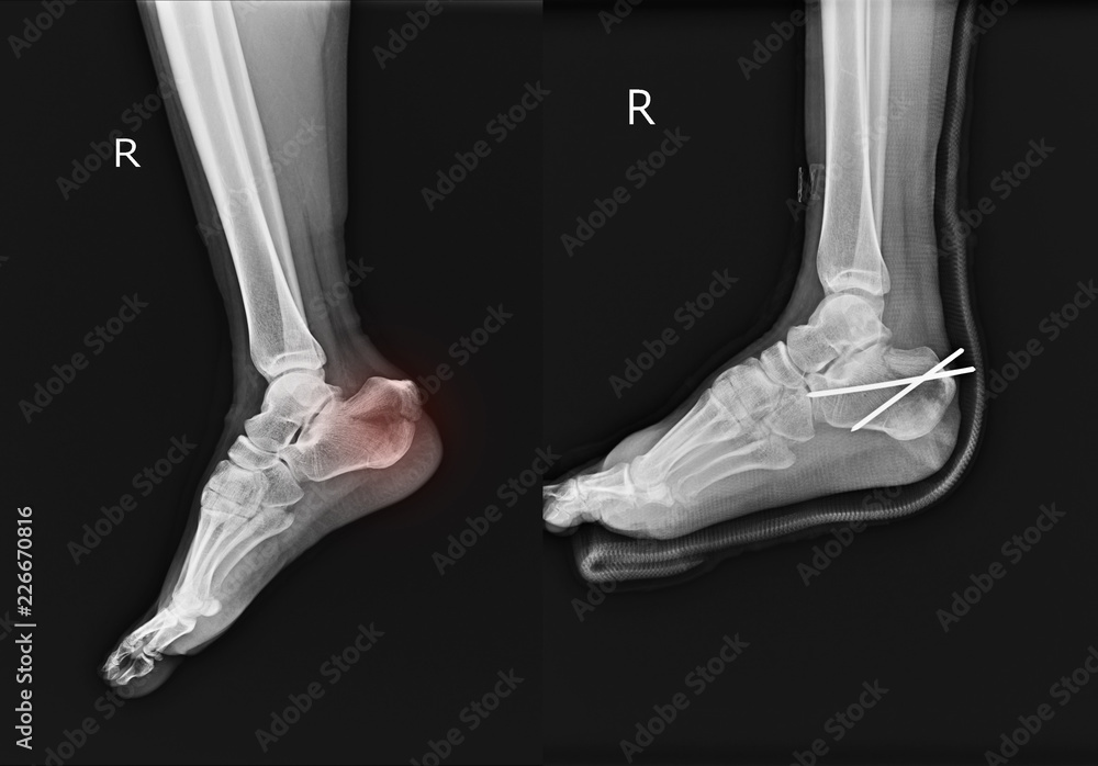 Poster X-ray Fracture calcaneus-heel and Post operation fixcation ...