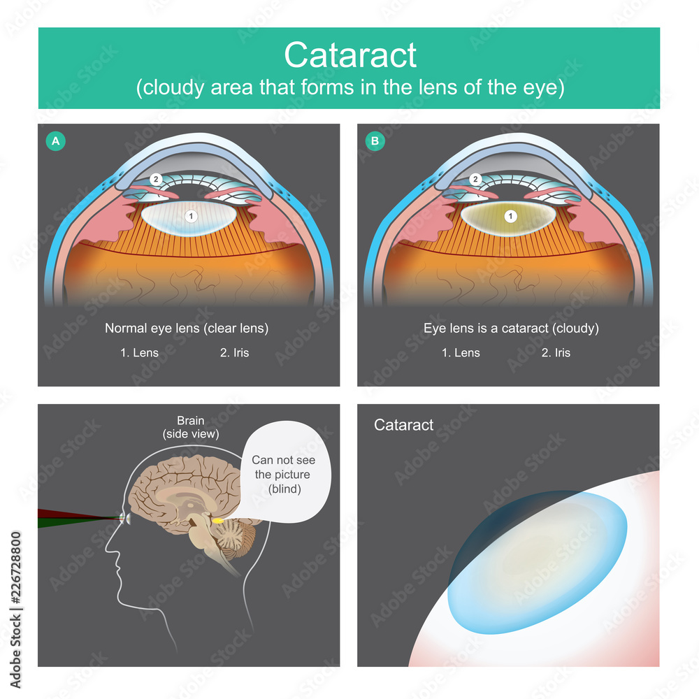 Cataract is a dense cloudy area that forms in the lens of the eye Stock ...