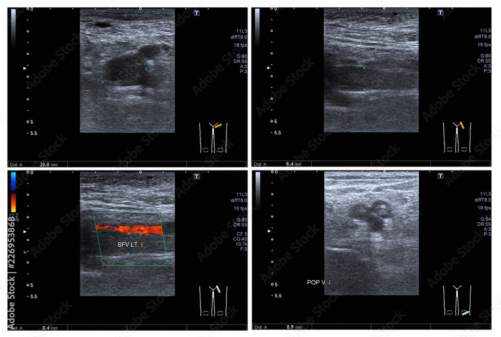 Ultrasound color doppler both leg:Hyperechoic thrombus with dilatation ...