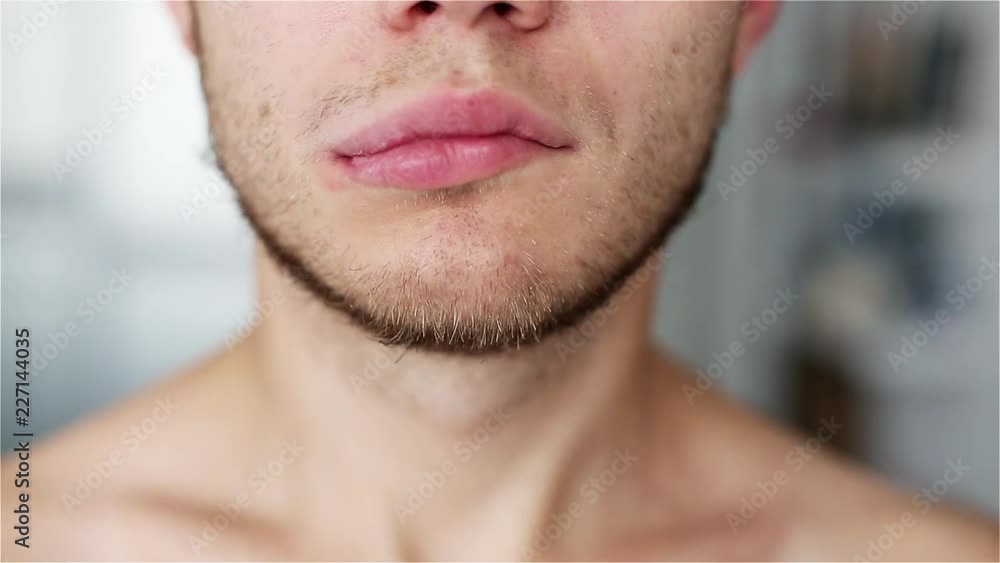 symptoms and effects of a brain stroke. asymmetry of the face lips of a ...