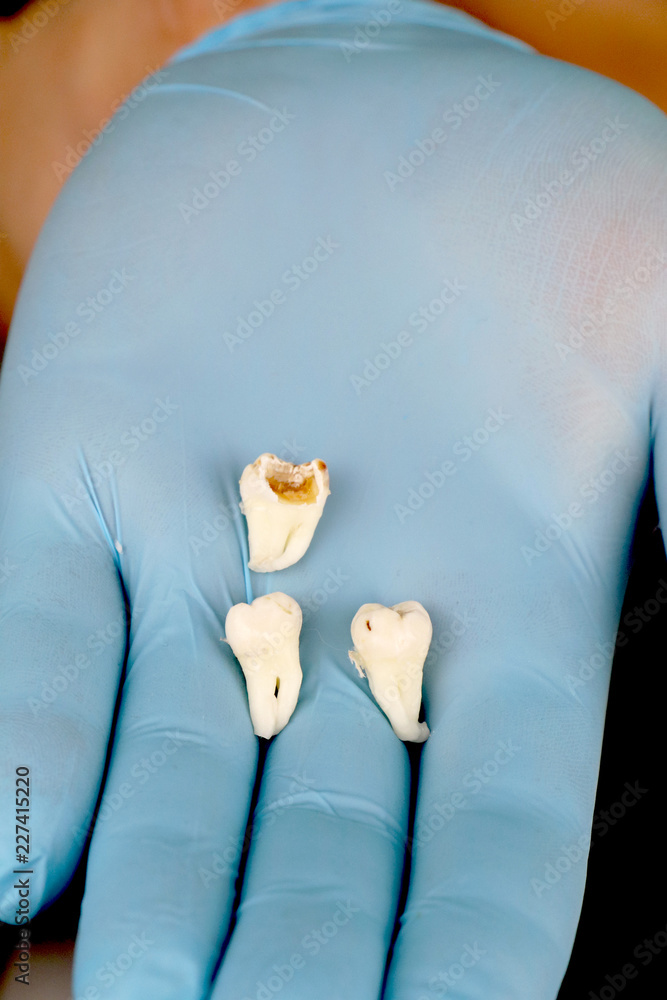 A man after removing a wisdom tooth. The operation to remove the eighth ...