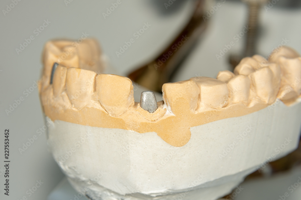 close-up human tooth together with a pin, is prepared by a bur under ...