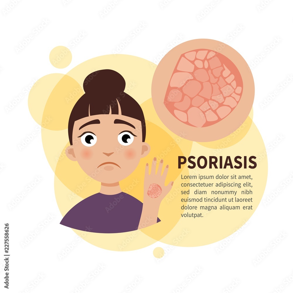 Vector poster. Psoriasis. Sad cute girl. Disease of the skin. Stock ...